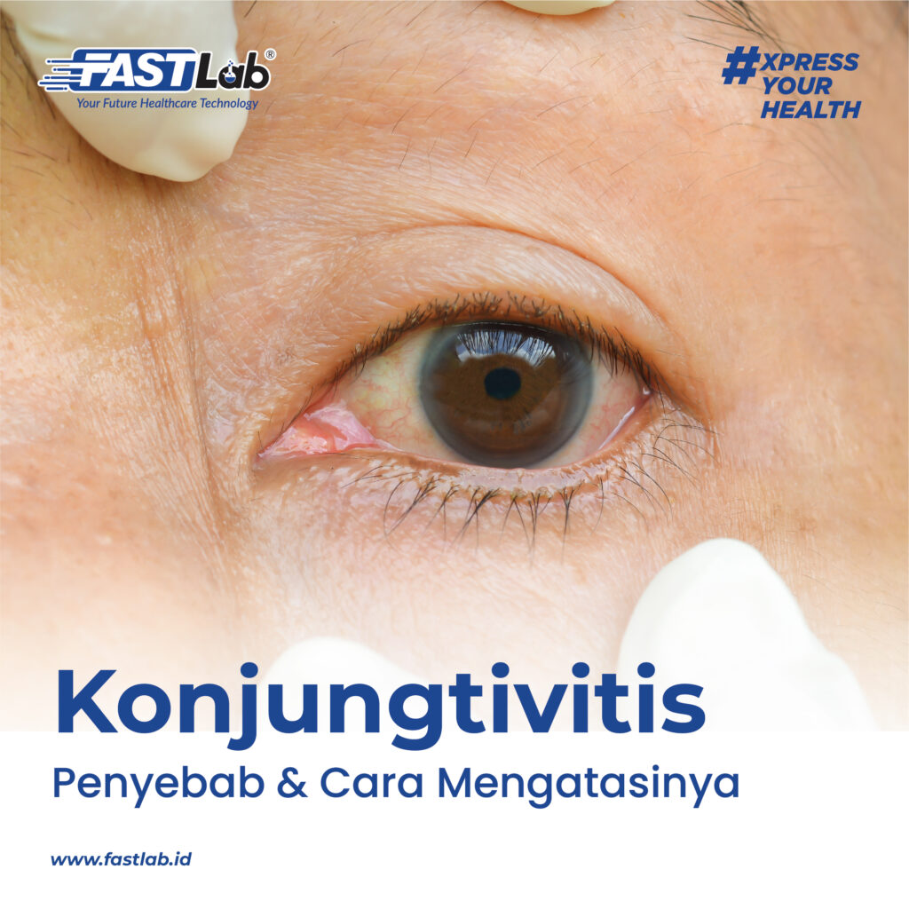 Apa itu konjungtivitis? Cari Tahu Cara Mengobatinya! - FASTLab ID